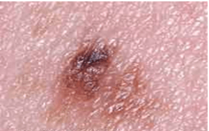 What Causes Moles to Suddenly Appear - Reasons, Types, Prevention