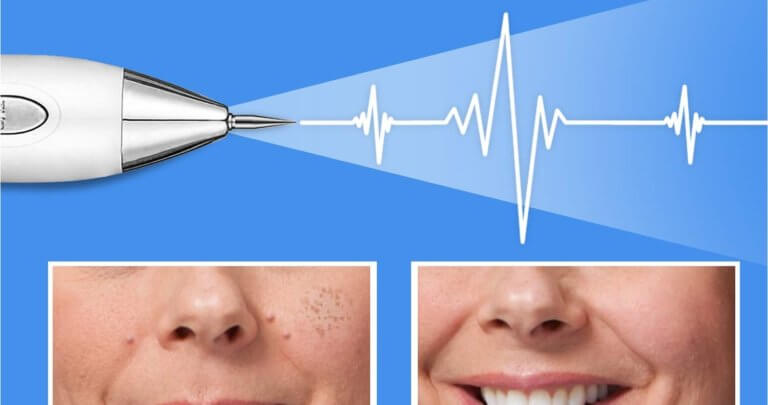 #1 Best Cautery pen for Skin tags & Moles | Cauterizing Pen Review